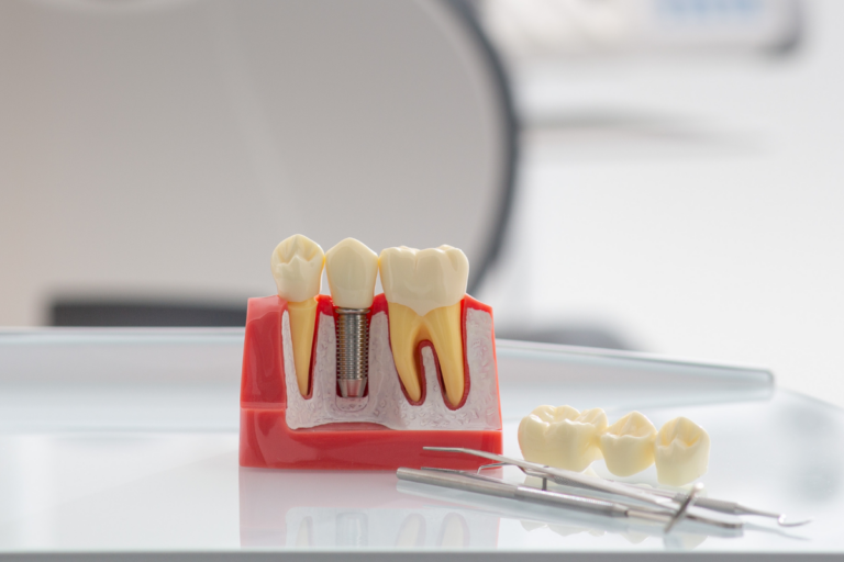 Pain After Dental Implants? Signs You Shouldn't Ignore